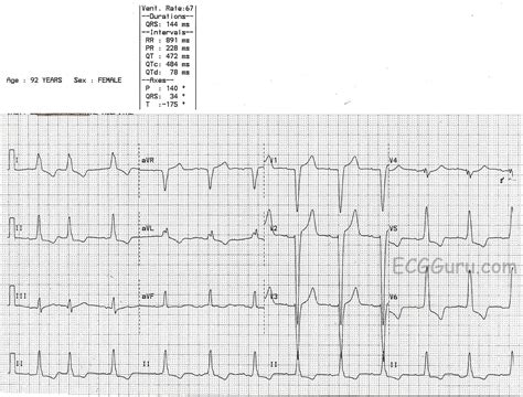 Left Bundle Branch Block ECG Guru Instructor Resources
