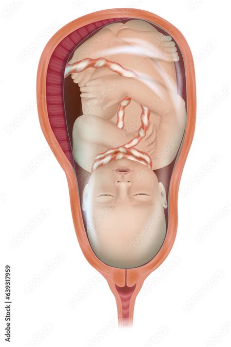 Umbilical Cord Entanglement In Pregnancy Umbilical Cord Compression