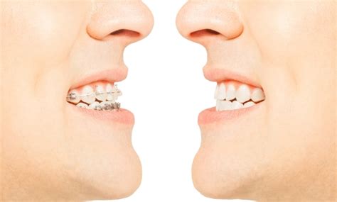How Is An Overbite Corrected Types Ways SmilePerfectors