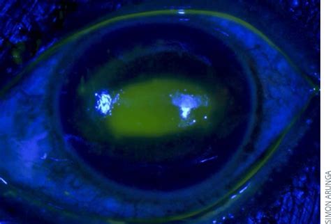 Emergency Management Microbial Keratitis Community Eye Health Journal