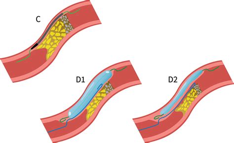 צנתור Cto צנתור לפתיחה של חסימה כרונית של עורק כלילי