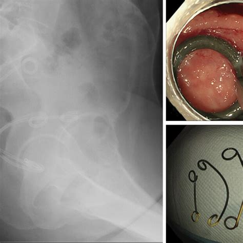 Endoscopy Showing Adherent Pus At The Diverticular Perforation Site Download Scientific Diagram