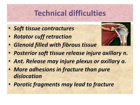 Neglected Proximal Humerus Fractures A Surgical Challenge Dr Mohamed Ashraf Hod Orthopaedics