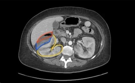 Emphysematous Pyelonephritis Ct Transverse Annotated Jetem 2023 Jetem