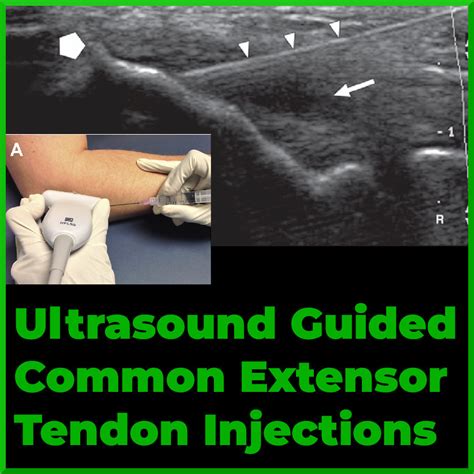 Ultrasound Guided Lateral Epicondyle Injection Sports Medicine Review