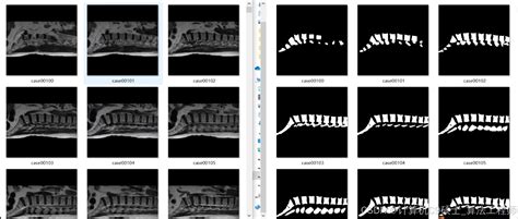 Yolov5如何训练使用mri 脊椎分割数据集 脊椎分割项目解决方法如何 原图，标签分别2460张 实现可视化及评估 Csdn博客