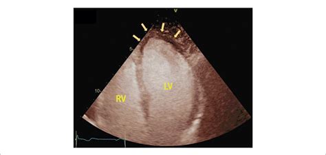 Contrast Echocardiography In Real Life Practicality Safety And Cost Effectiveness Abc Imaging