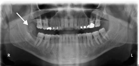 Peripheral Ossifying Fibroma Radiograph