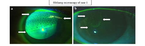 A Superficial Vortex Pattern Keratopathy White Arrows On The Upper