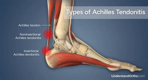Achilles Tendonitis Understandortho™