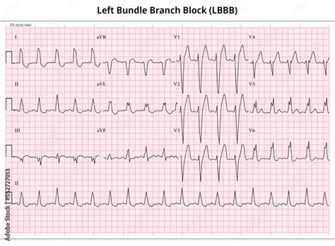Ecg Left Bundle Branch Block Ecg Paper 12 Lead Stock Vector Adobe Stock