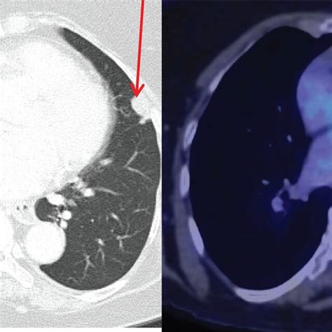 High‐resolution Computed Tomography Chest Images Left And Computed
