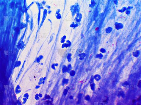 痰涂片中结核分枝杆菌阳性