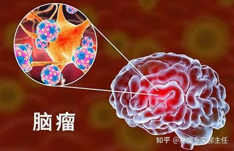 脑肿瘤形成原因有哪些？ 知乎