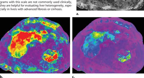 Figure 3 From Liver Mr Elastography Technique And Image Interpretation Pearls And Pitfalls
