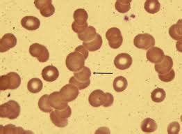 Gambar Kelainan Eritrosit Erytrosit Abnormal CocoQuiins Blog