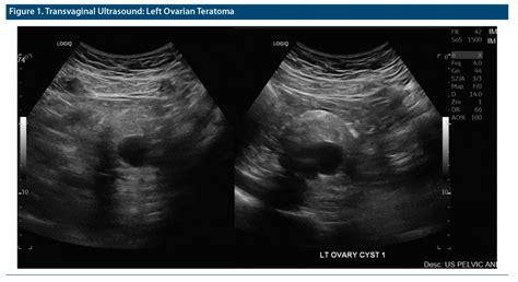 Ovarian Teratoma Ultrasound