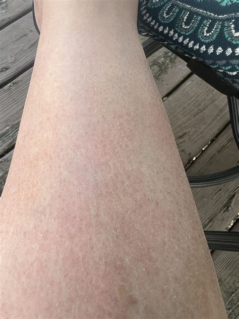 Any Suggestions For This My Calves Always Look Terrible R