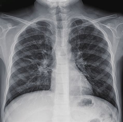 Chest X Ray Demonstrating Diffuse Bilateral Bronchiectasis Download Scientific Diagram