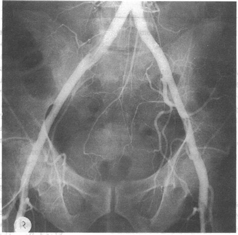 Chest X Ray Showing Pulmonary Consolidation In The Left Mid Zone L L ~ Download Scientific