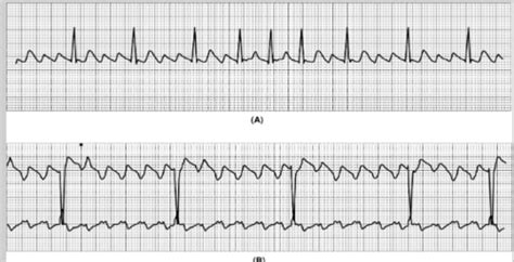 Interpretation Of Abnormal EKG Atria Flashcards Quizlet