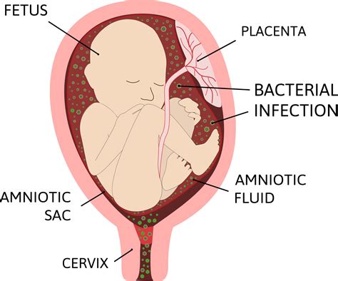 Chorio Infection What Is Chorioamnionitis Chorioamnionitis Meaning Chorioamnionitis Effects