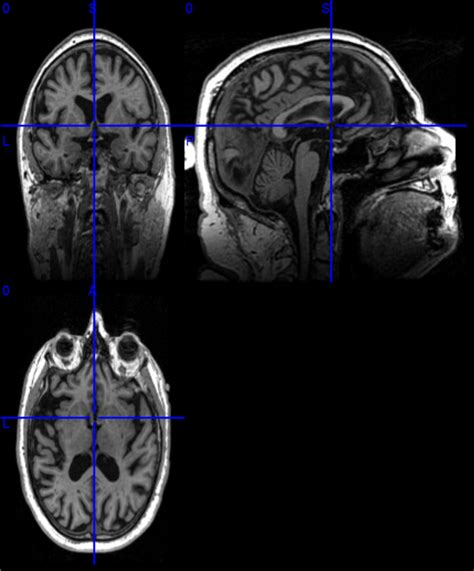 Mri图像预处理流程mri图形预处理 Csdn博客