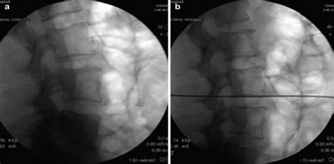 Lateral Lumbar Interbody Fusion Llif For The Treatment Of Adult Spinal Deformity Asd