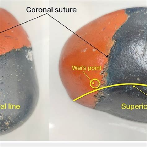 Weis Point Is Located 05 Cm Medial To The Superior Temporal Line And
