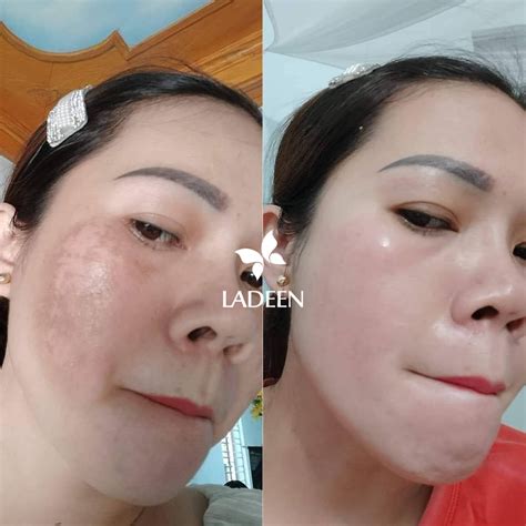 Melasma Symptoms Causes And Treatment Options