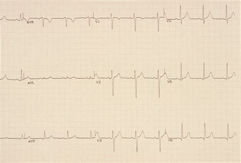 Electrocardiogram Ecg Or Ekg Procedure And Results