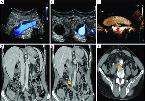 The Imaging Before Drug Treatment A The Us Long Axis View Of The