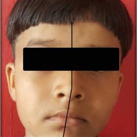 Pdf Preventive Orthodontic Approach For Functional Mandibular Shift