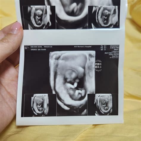 임신 13주차 초음파 정밀검사 기형아 검사하기 네이버 블로그
