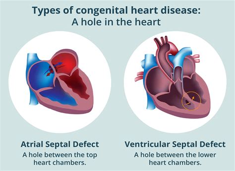 Congestive Heart Failure