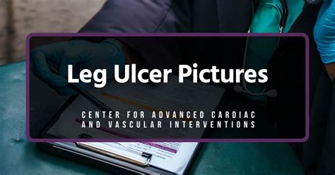 Leg Ulcer Pictures 2025 Cacvi