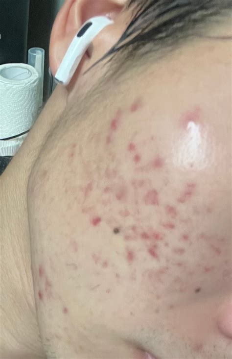 여드름 흉터 색소침착 지식in