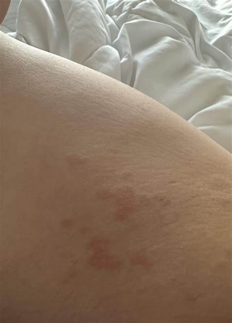 Rashes On Both Inner Thighs Rdermatology