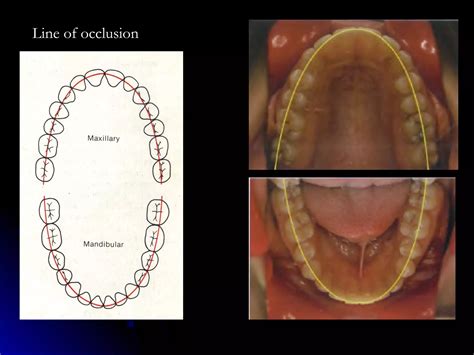 Classification Of Normal Occlusion And Malocclusion Ppt Dental Health Diseases And Conditions