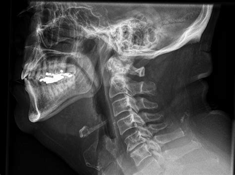 What Is Cervical Radiculopathy Spine Health 45 Off