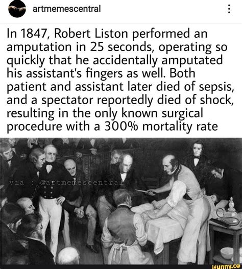The Good Ol Days In 1847 Robert Liston Performed An Amputation In 25 Seconds Operating So