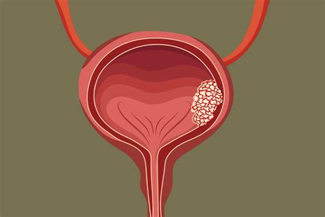 Bladder Tumor Resection In Nyc Dr David Samadi Urologic Oncologist