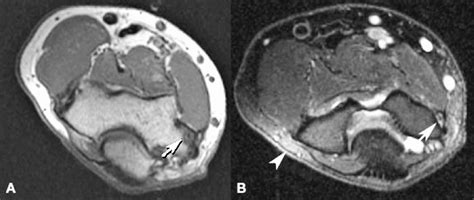 An Axial T1 ­weighted Spin Echo Mr Image A And An Axial Fat