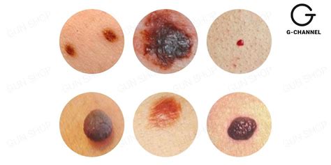 Nốt Ruồi Ở Dương Vật Có Ý Nghĩa Gì Theo Từng Vị Trí