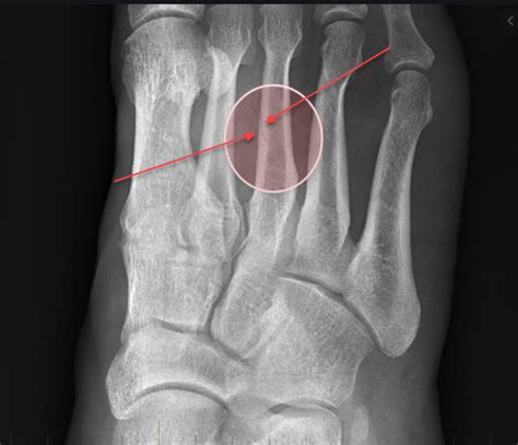 Stress Fracture Osteomag