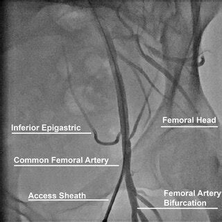 Femoral Access Ultrasound A Femoral Artery Ultrasound Shows A