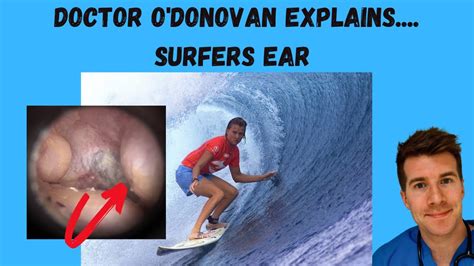 Explaining Surfers Ear Aka Exostosis With Dr Odonovan Youtube