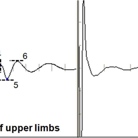 Latency And Amplitude Measurement Of Tes Meps And Sseps The Stimulus Download Scientific