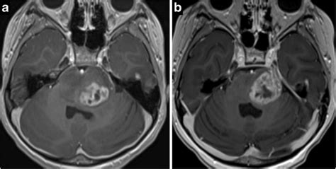 Neuroimaging Of Meckels Cave In Normal And Disease Conditions