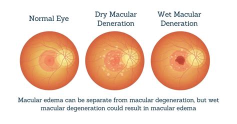 Cystoid Macular Edema Cme Treatment In Delhi Causes And Prevention
